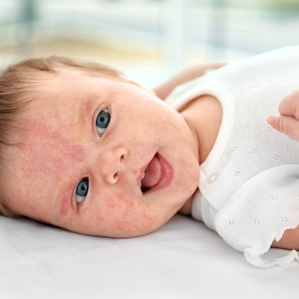 Peau atopique : Comment traiter avec la gamme AtopiControl ? - Le blog ...