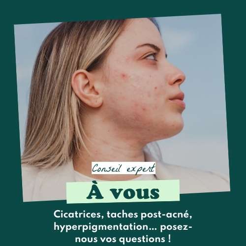 Boutons sur le visage : signification selon leur emplacement